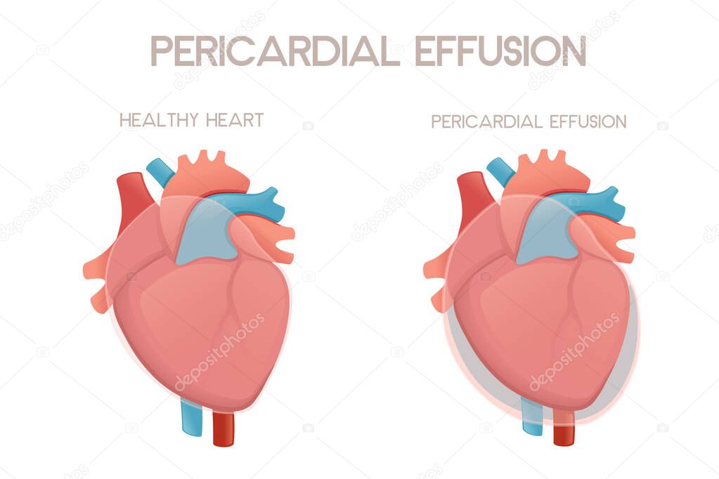 Corazón y corazón humano sano con pericarditis enfermedad anatomía ...