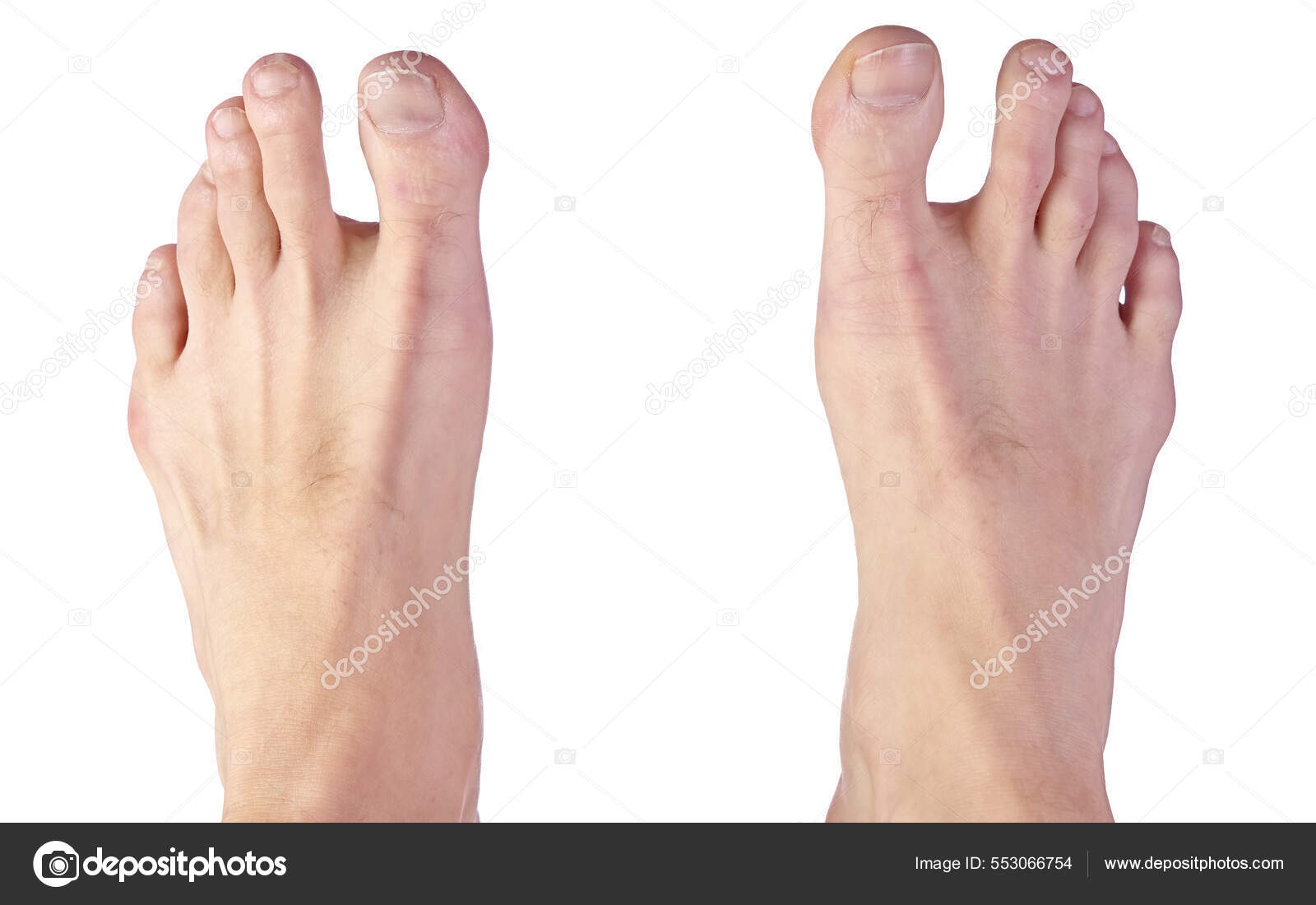 Close up of a Mans Feet Showing Sandal Gap Deformity, also known as ...