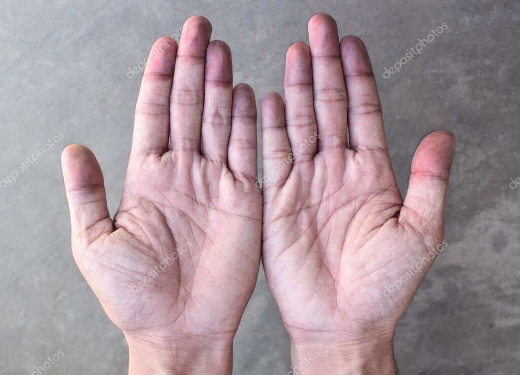 Manos cianóticas o cianosis periférica o manos azules en el sudeste ...