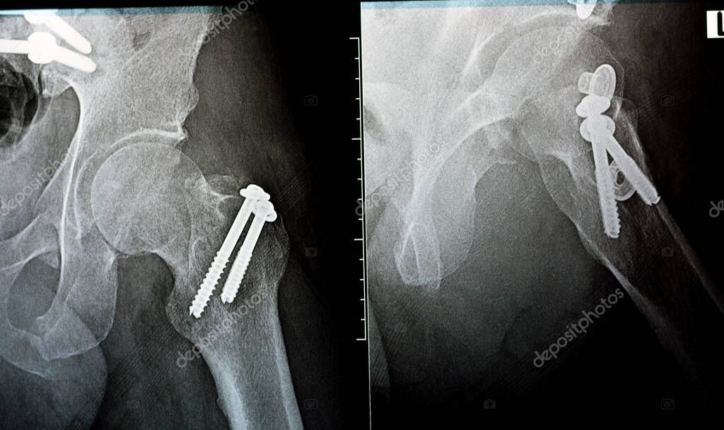 Enfoque selectivo de una radiografía simple en cadera izquierda unido a ...