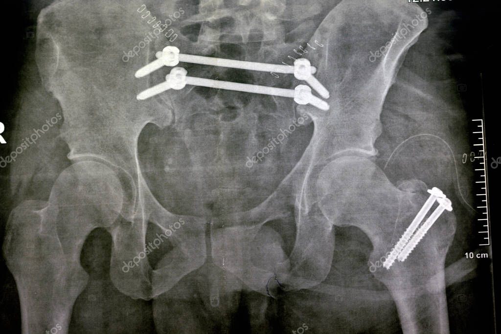 Radiografía simple con una fractura de pelvis que se fija con 4 ...