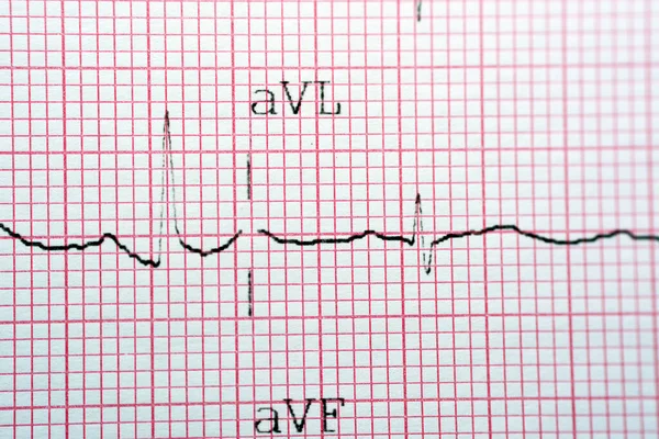 Ecg Electrocardiograph Paper Shows Normal Sinus Rhythm Nsr Frequent ...