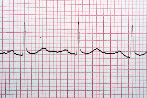 Ecg Electrocardiograph Paper Shows Normal Sinus Rhythm Nsr Frequent ...