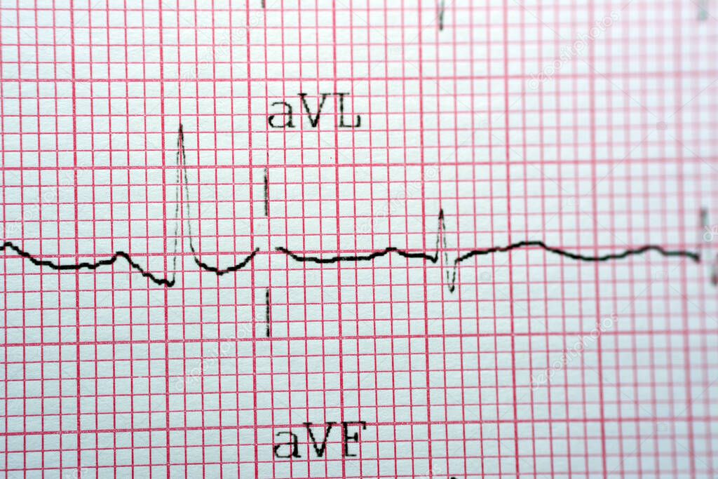 Electrocardiogram ECG in a graph paper shows normal Sinus rhythm, Vital ...