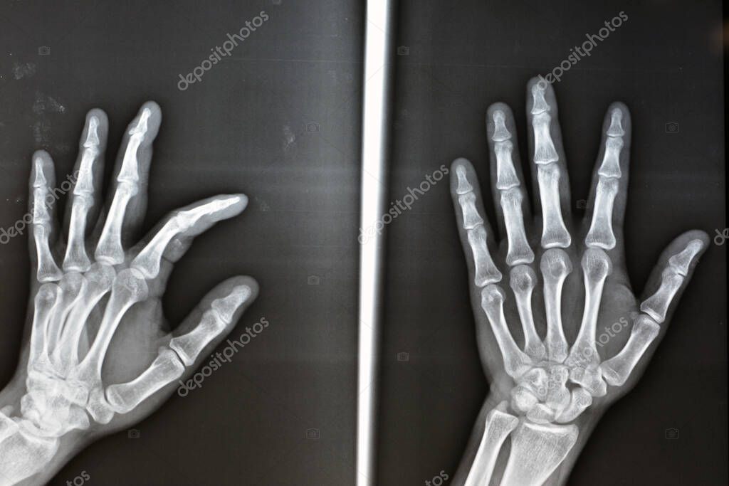 Plain x ray shows avulsion fracture base of the distal phalanx of the ...