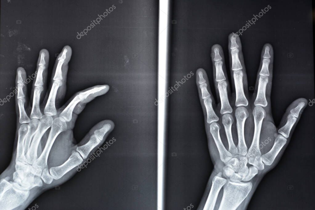 La radiografía muestra la base de la fractura por avulsión de la ...