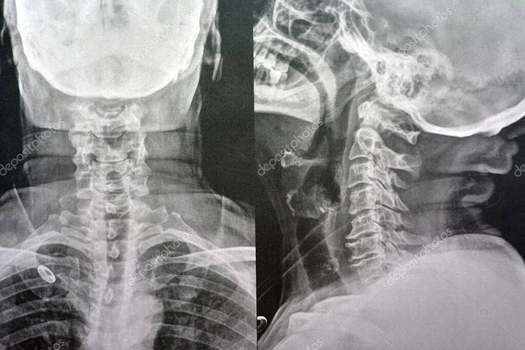 Plain X ray cervical vertebrae showing straightening of cervical ...
