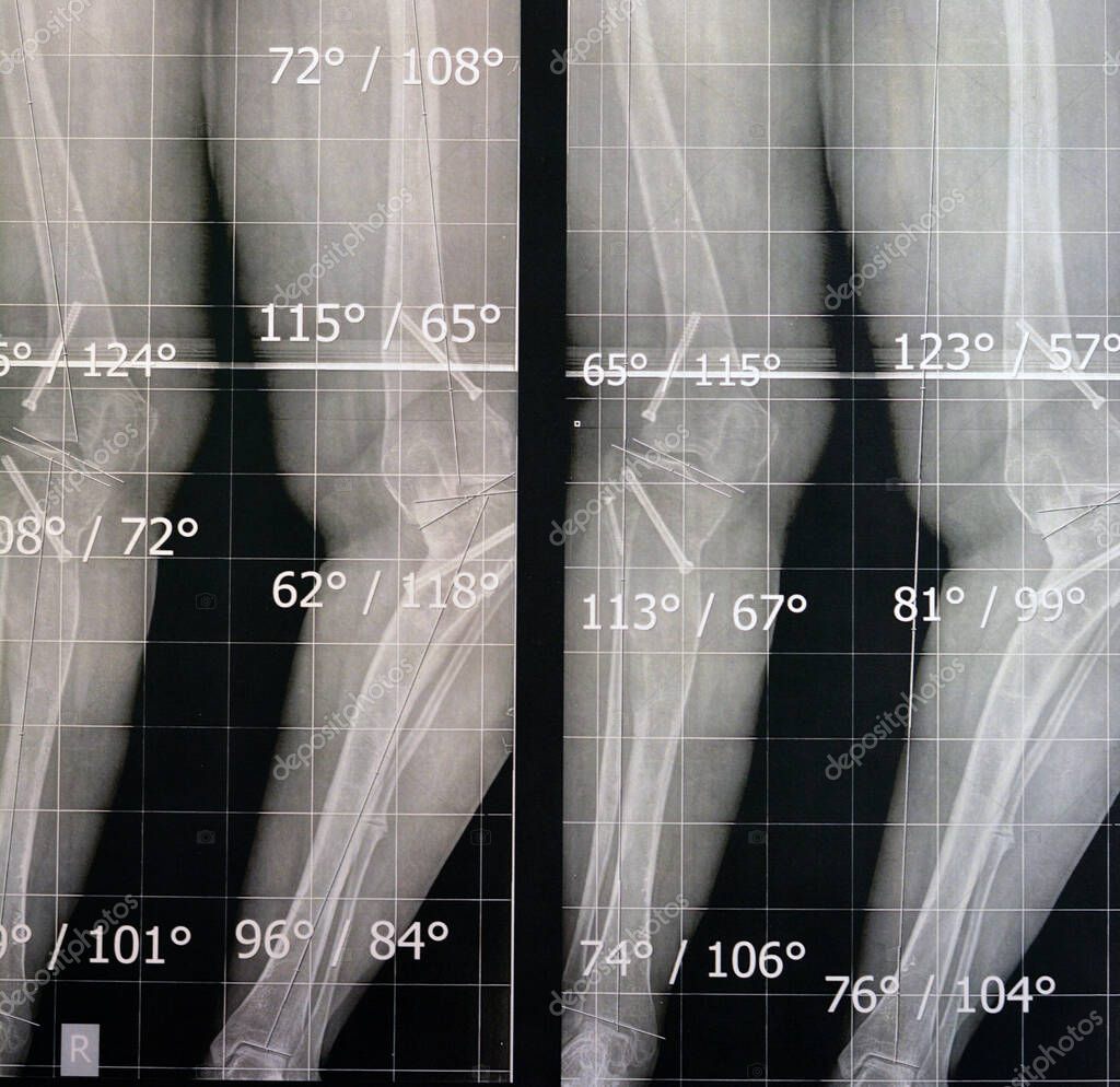 Película larga de rayos X en posición de pie que muestra ambas piernas ...