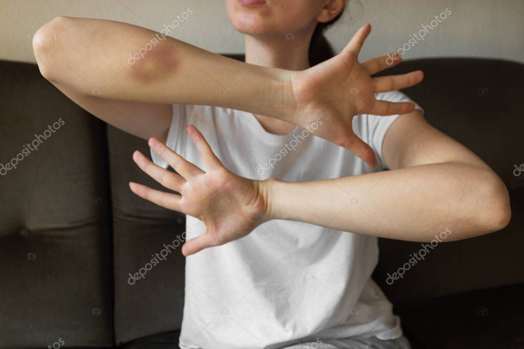 Mujer joven en camiseta blanca con grandes moretones en el brazo. Decir ...