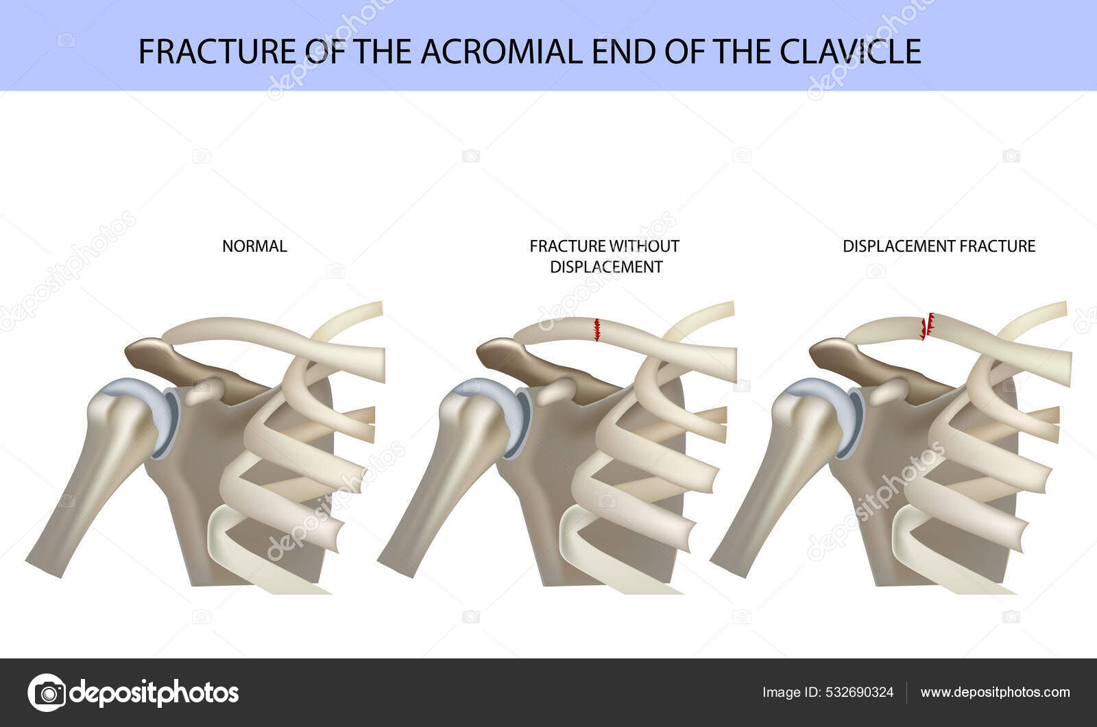 Fracture Of The Acromial End Of The Clavicle Medical Vector Illustration Stock Vector Image By