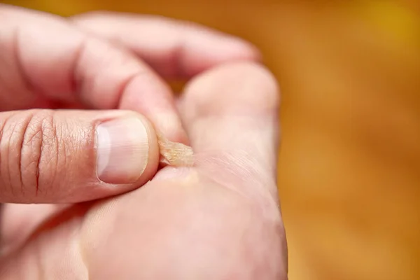 Removal of calluses Stock Photos, Royalty Free Removal of calluses ...