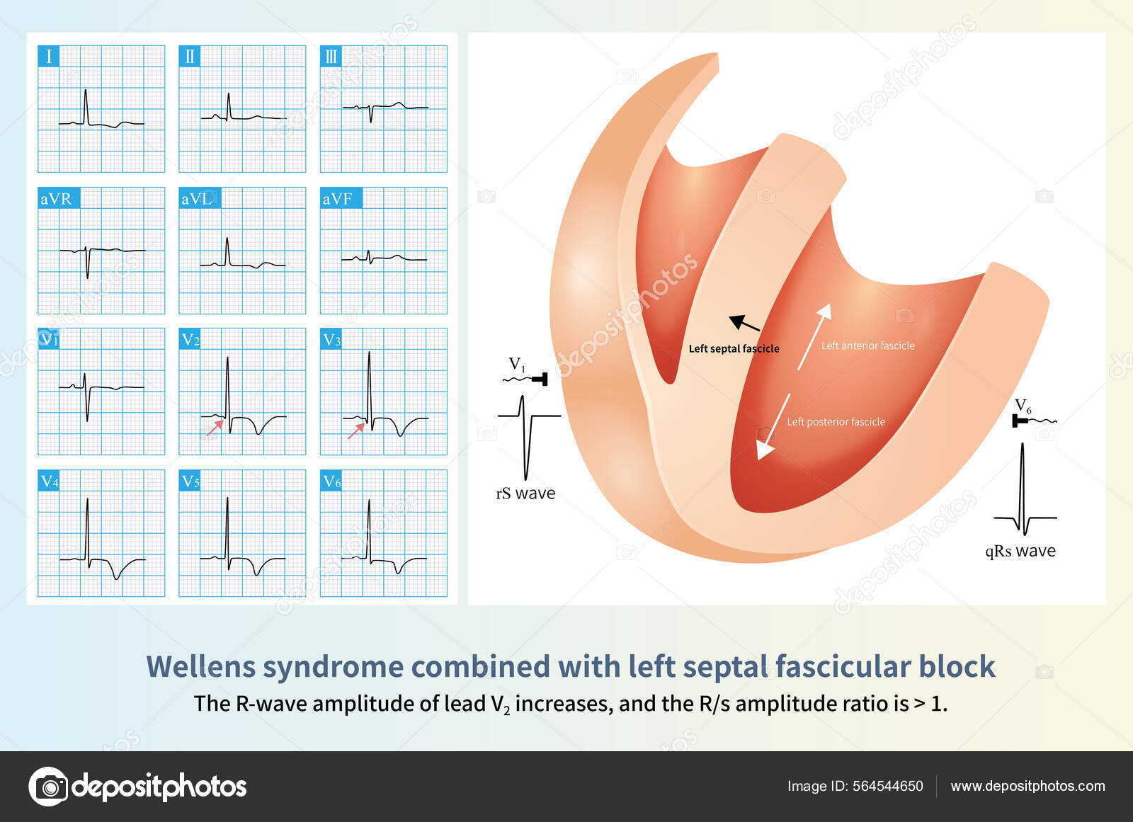 Female Years Old Ecg Collected Onset Chest Pain Wellens Syndrome Stock ...