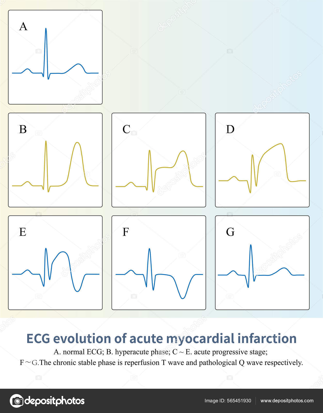 Segment Elevation Myocardial Infarction Ecg Undergo Characteristic Evolution Process Finally ...