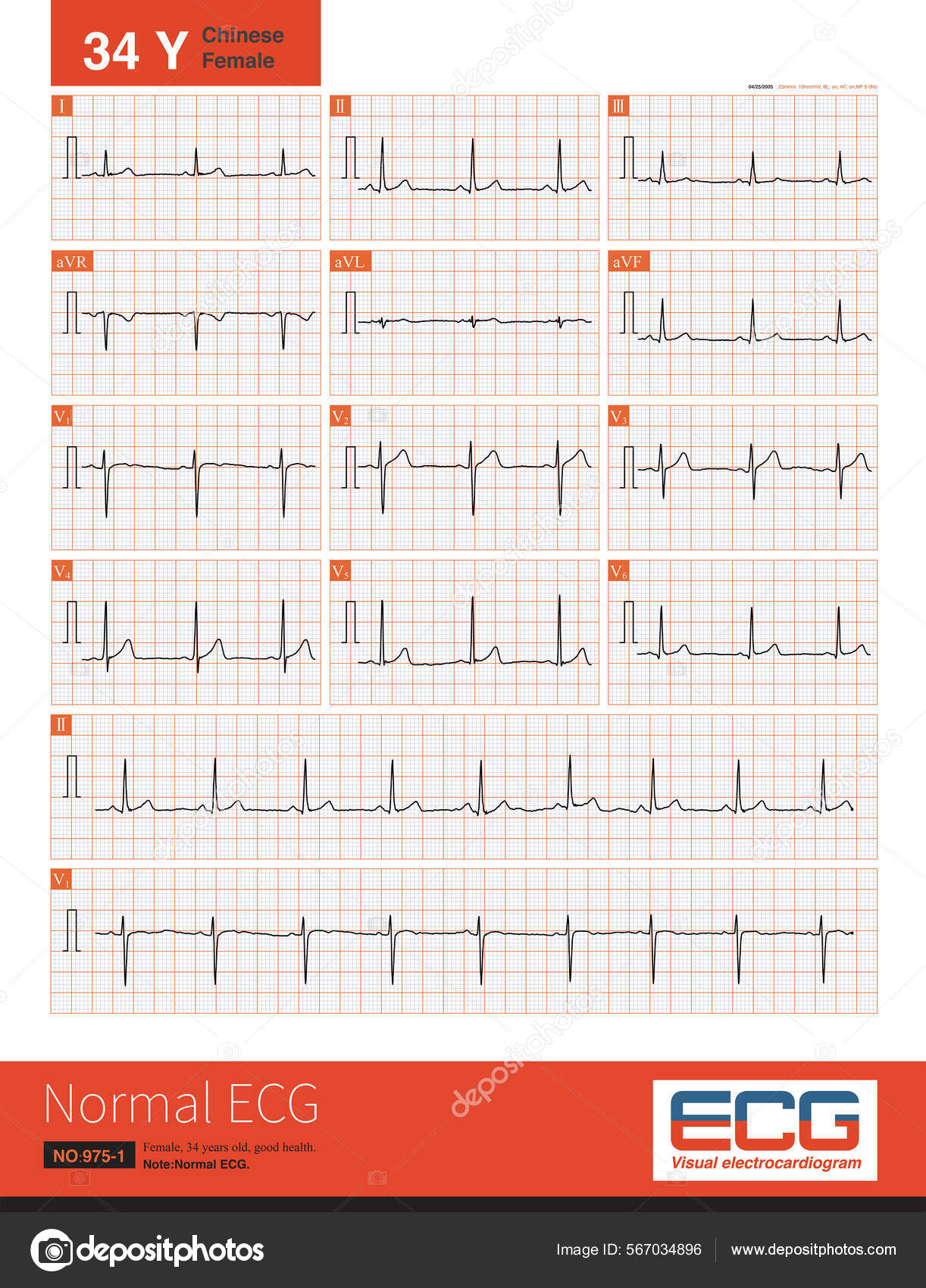 Normal Electrocardiogram Year Old Chinese Healthy Woman Rhythm Sinus ...