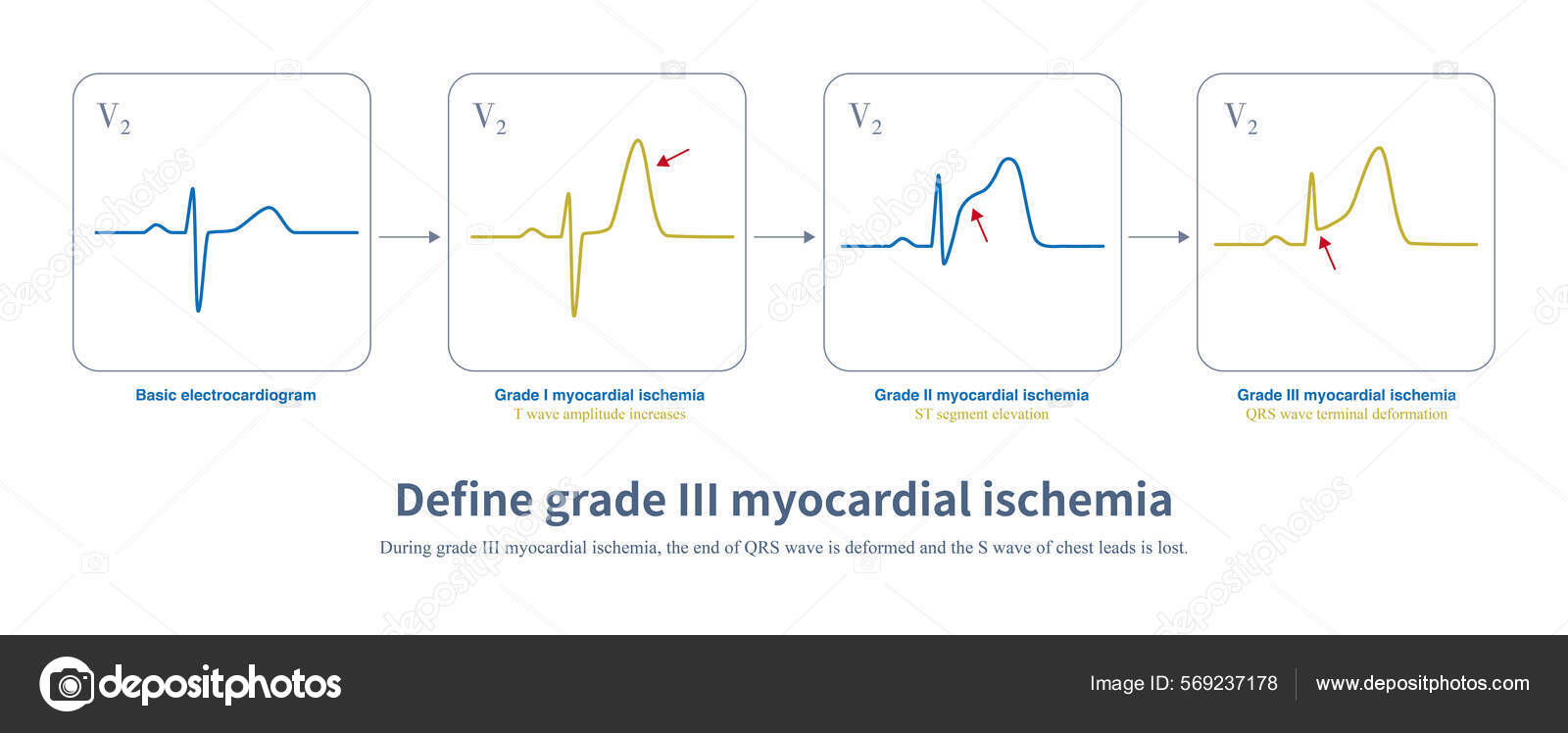 T Wave Elevation