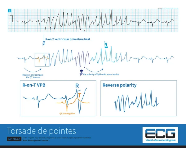 Torsade de pointes Stock Photos, Royalty Free Torsade de pointes Images ... Torsade de pointes Stock Photos, Royalty Free Torsade de pointes Images ...