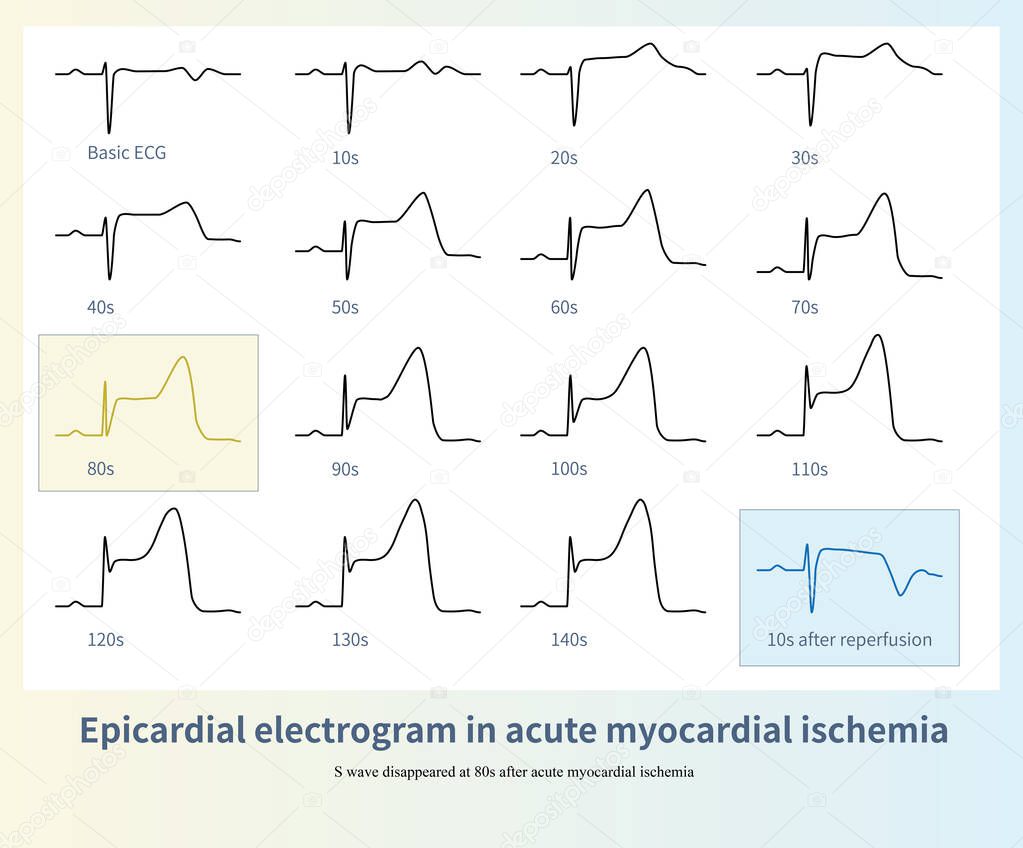 El electrograma epicárdico de isquemia miocárdica aguda se registró ...