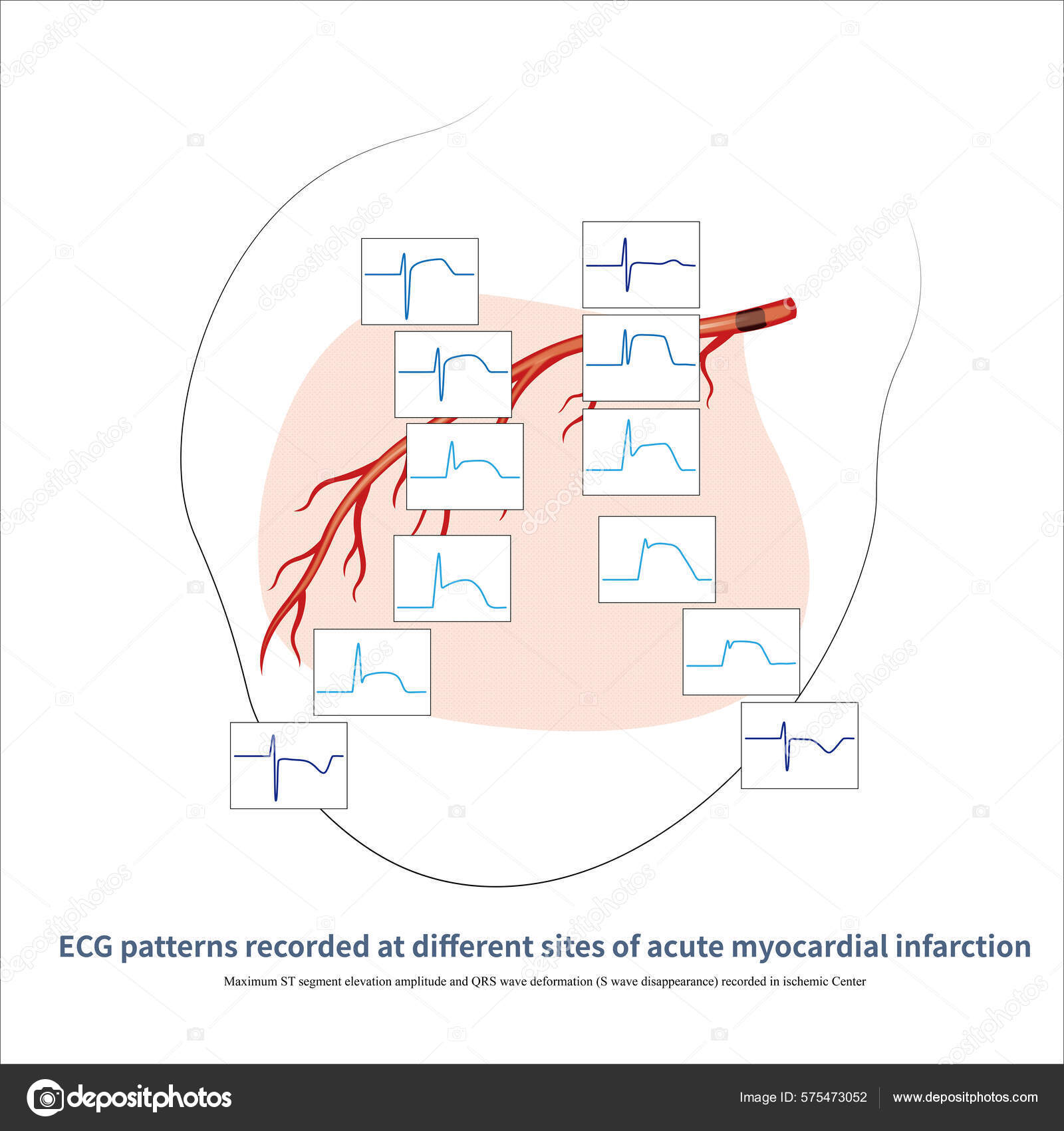 Acute Myocardial Infarction Ecg Patterns Different Ischemic Center ...