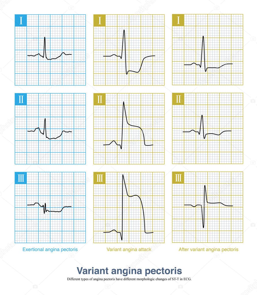 Los diferentes tipos de angina de pecho tienen diferentes patrones de ...