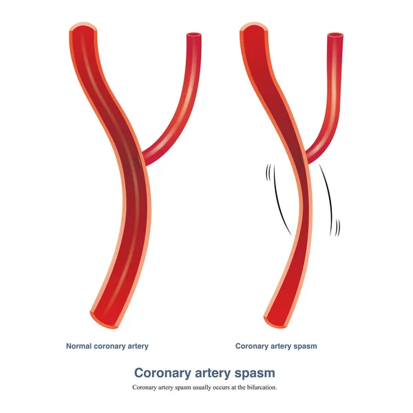 Coronary Artery Spasm Causes Transmural Myocardial Ischemia Segment ...