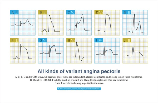 During the onset of variant angina pectoris, ECG is divided into non ...
