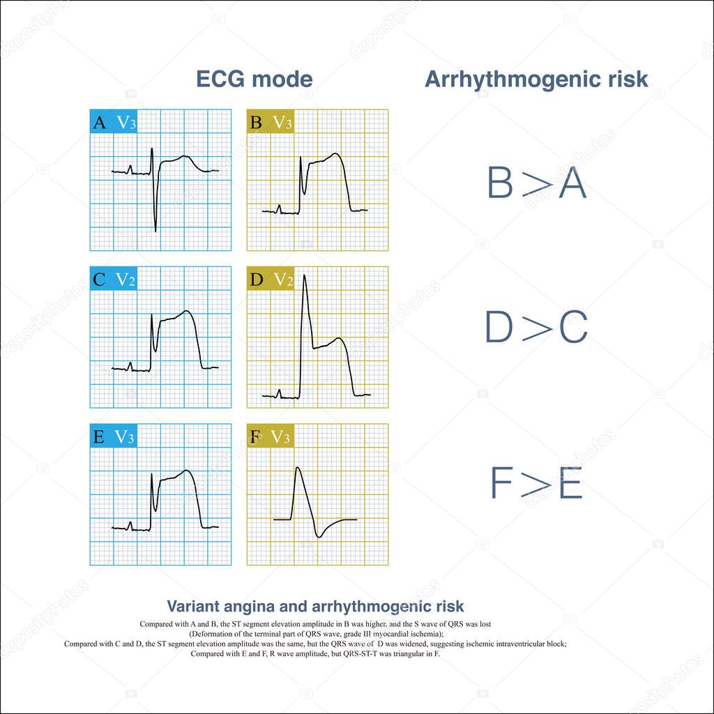 During the onset of variant angina pectoris, careful observation of QRS ...