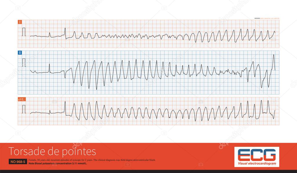 Torsade de pointes refers to the pleomorphic ventricular tachycardia ...