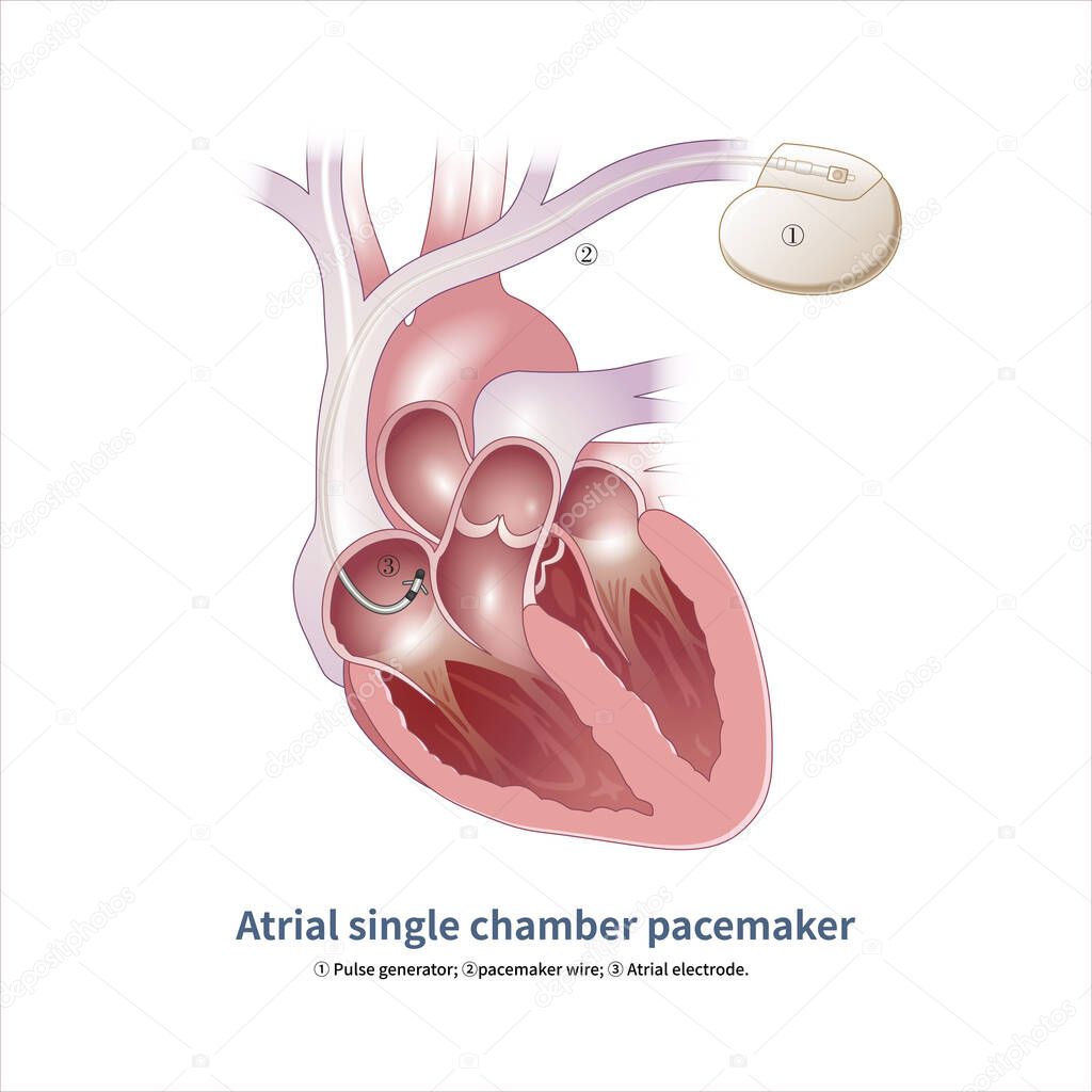 Atrial single chamber pacemakers have only one electrode placed in the ...