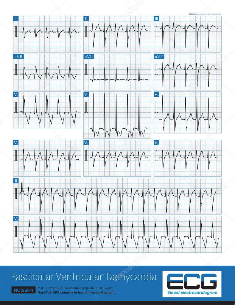 A fascicular ventricular tachycardia is an idiopathic ventricular ...