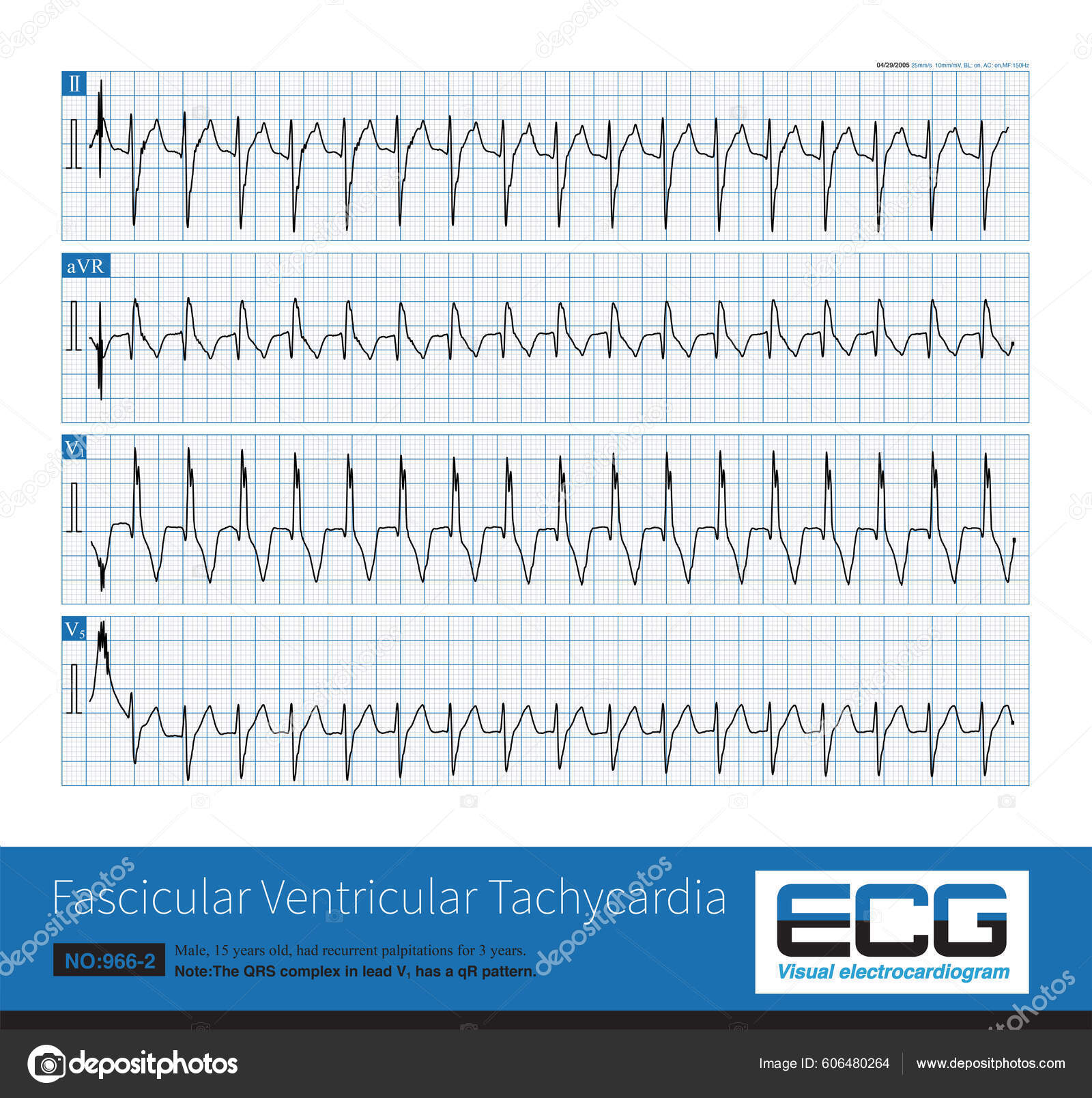 Fascicular Ventricular Tachycardia Idiopathic Ventricular Tachycardia ...