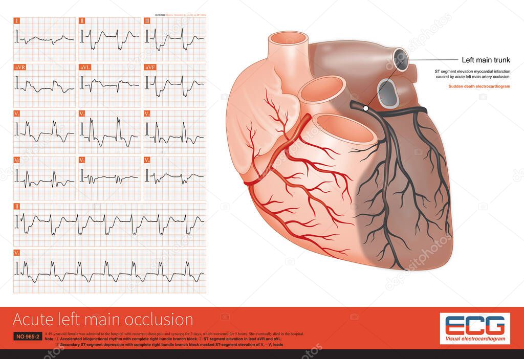 The coronary angiography showed complete occlusion of the left main ...
