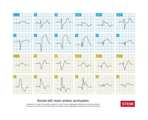 Left main artery Stock Photos, Royalty Free Left main artery Images ...