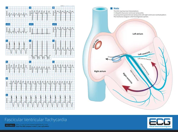 A fascicular ventricular tachycardia is an idiopathic ventricular ...
