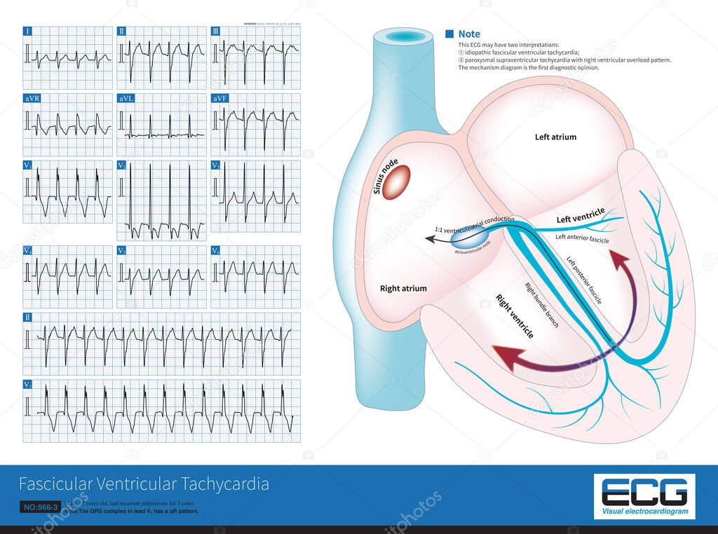 A fascicular ventricular tachycardia is an idiopathic ventricular ...