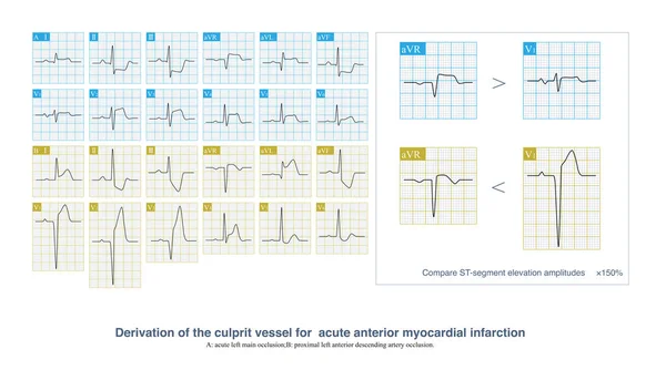 Quando Infarto Agudo Miocárdio Lateral Inferior Ocorre Simultaneamente ...