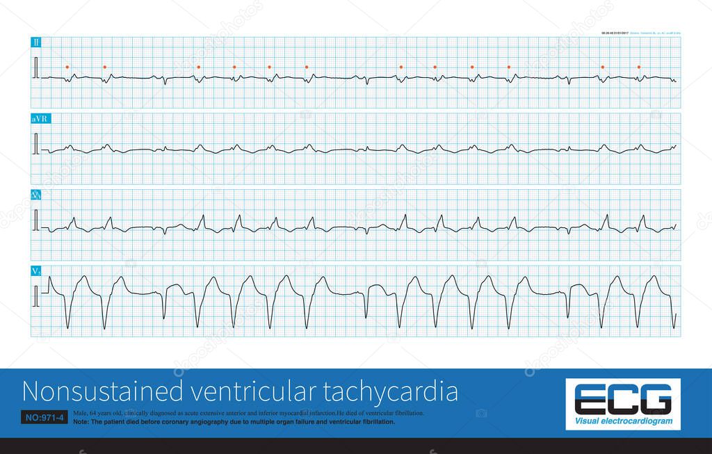 Se presenta un paciente con infarto agudo de miocardio anterior extenso ...