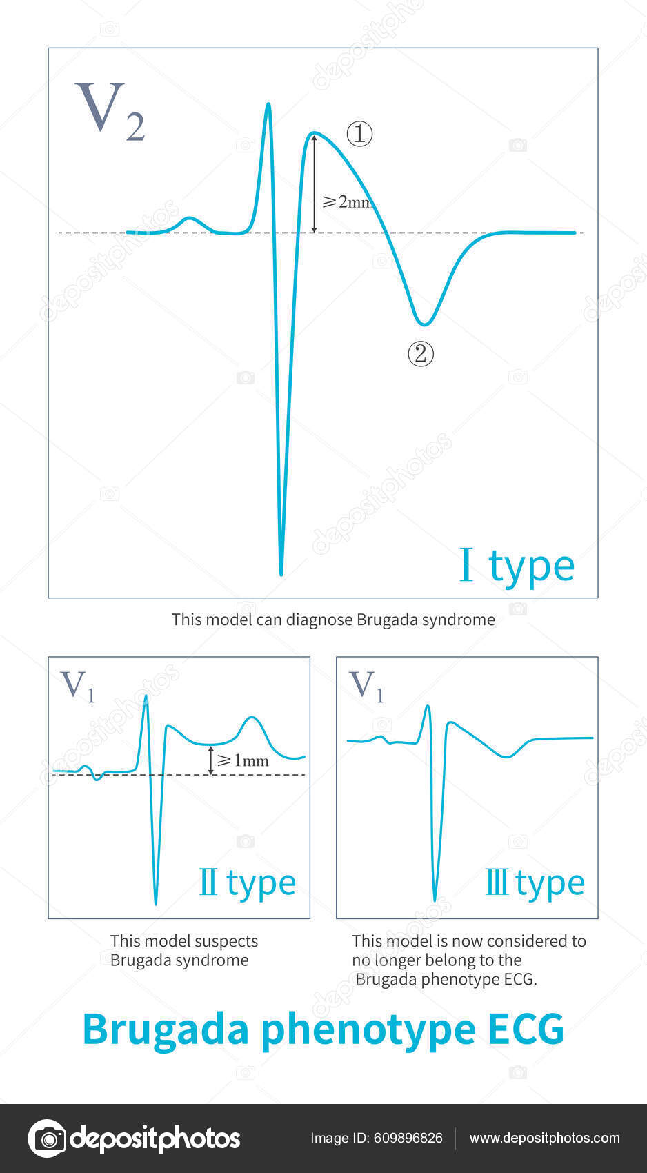 Only Type Brugada Phenotype Ecgs Can Directly Diagnose Brugada Syndrome ...