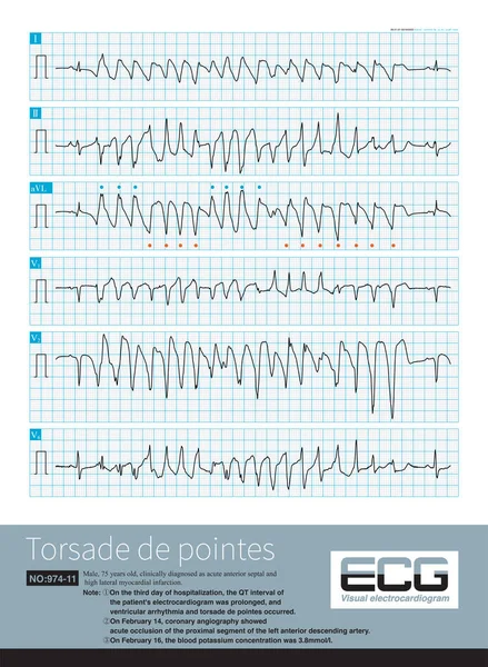Torsade de pointes Stock Photos, Royalty Free Torsade de pointes Images ... Torsade de pointes Stock Photos, Royalty Free Torsade de pointes Images ...