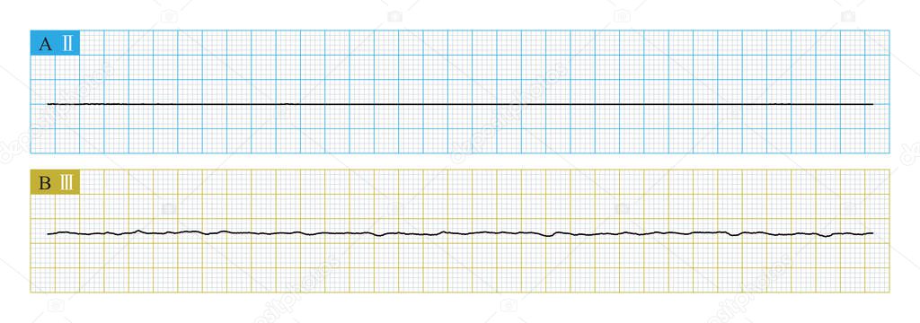 La figura A muestra el paro cardíaco total, y la figura B muestra la ...