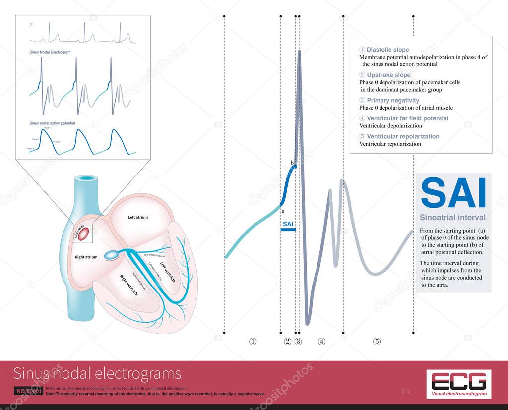 El electrograma de nódulo sinusal es una técnica para registrar la ...
