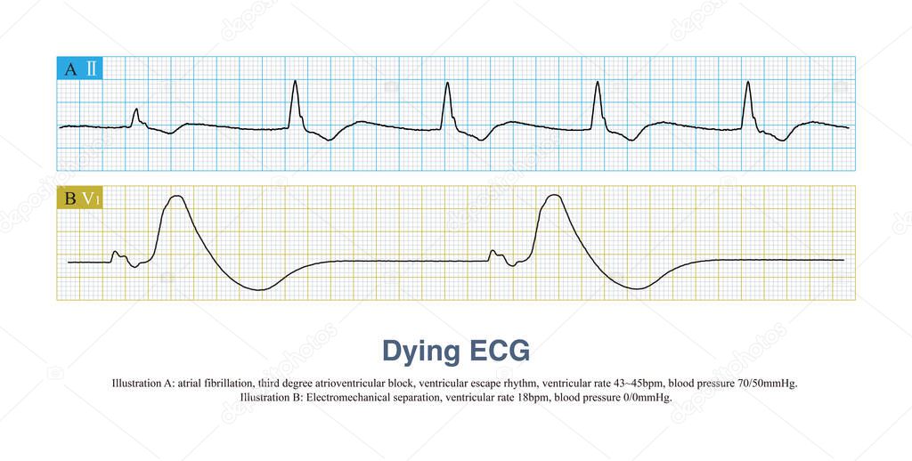 La separación electromecánica es un ECG de paro cardíaco. El corazón ...