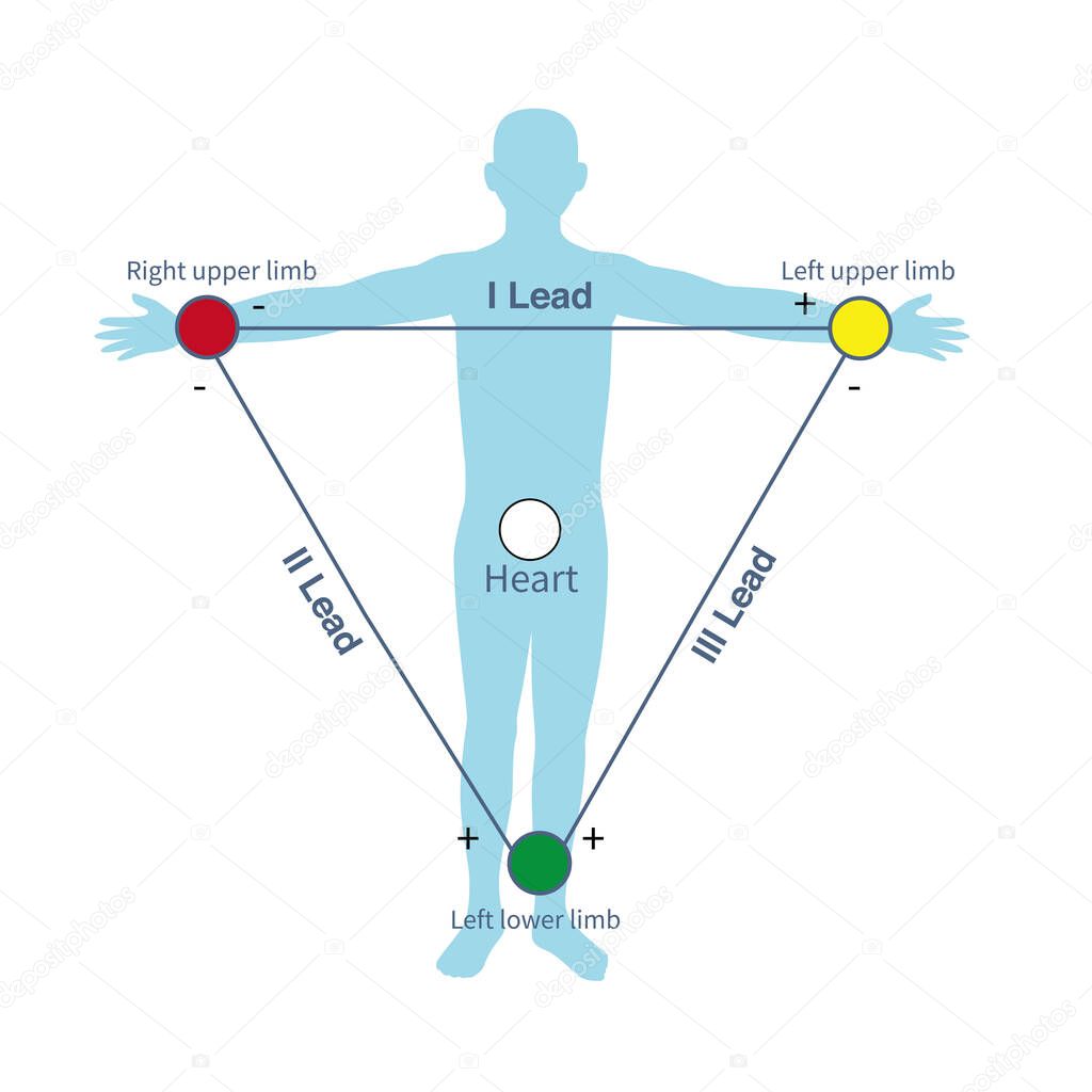 El triángulo de Einthoven asume que el miembro superior izquierdo, el ...