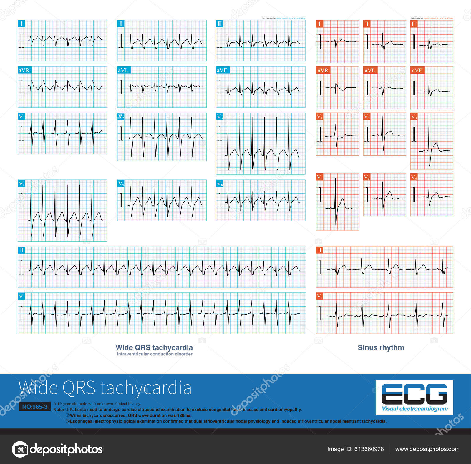 Disturbio Da Condução Intraventricular - RETOEDU