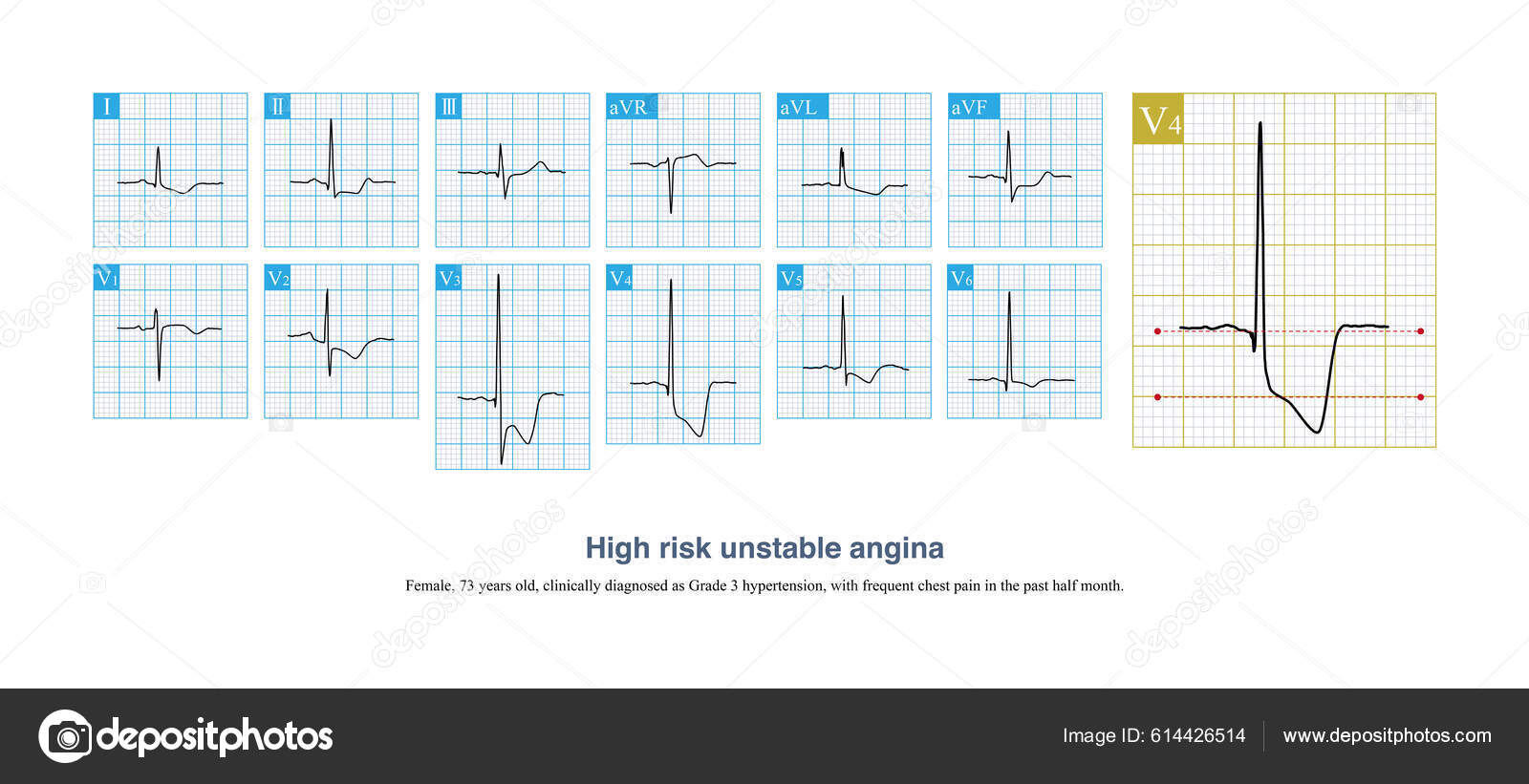 Unstable Angina Ecg