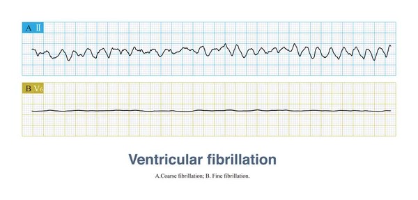 Fine Ventricular Fibrillation Vs Asystole