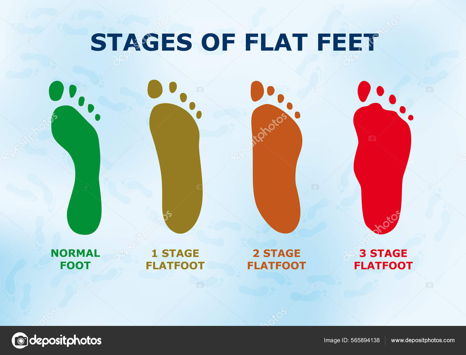 Supination Footprint