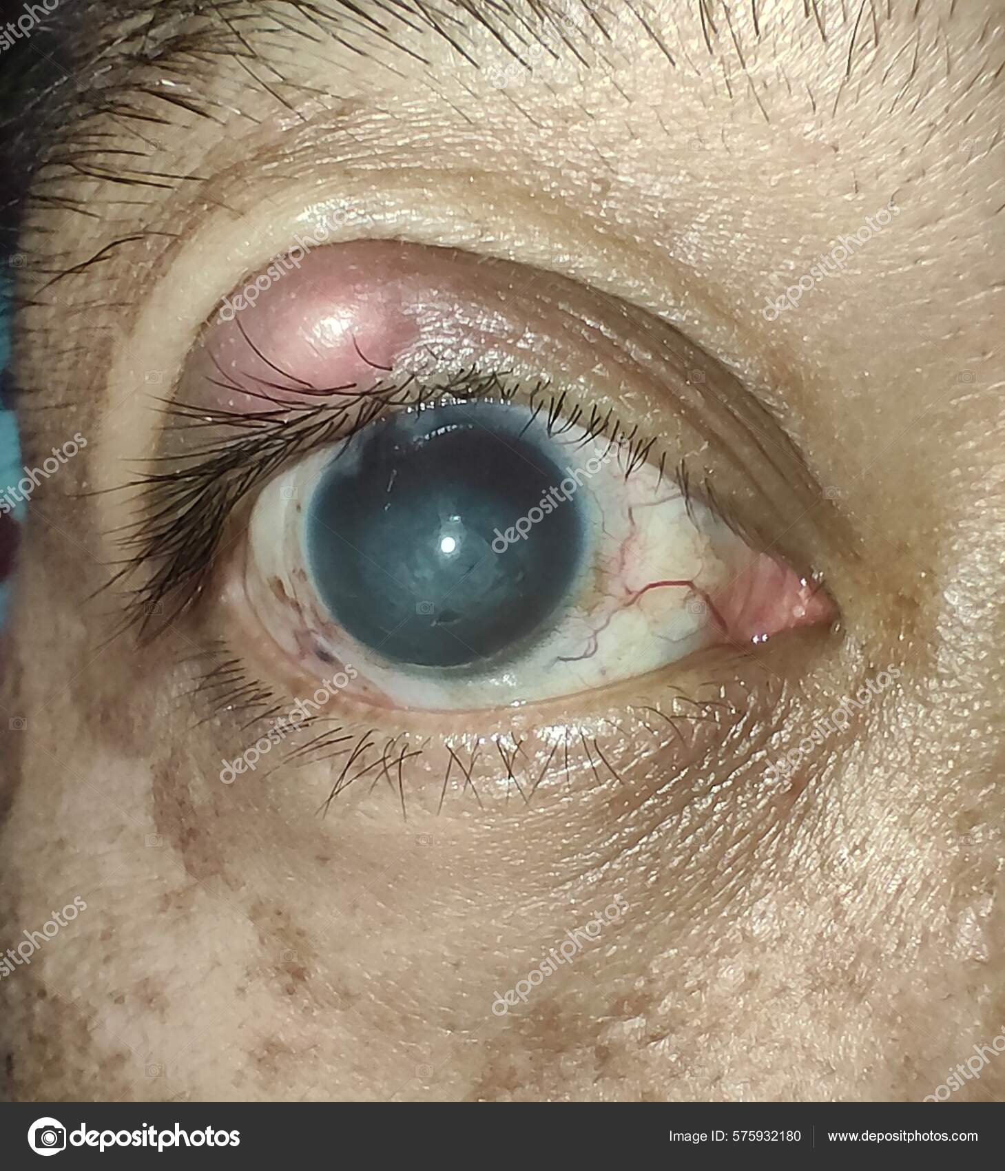 Swollen Eyes Glaucoma Red Pus — Stock Photo © 86mady #575932180