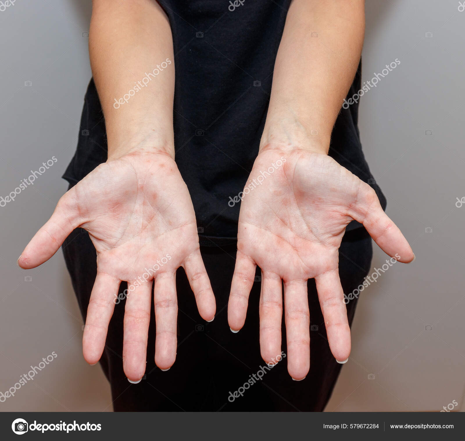 Eczema Nas Palmas Das Maos SciELO Brasil Eritromelalgia Primária: