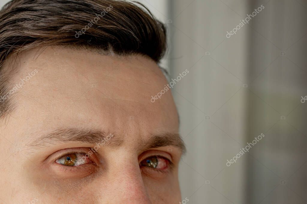 Un hombre con un ojo rojo y dolorido. Una infección durante la ...