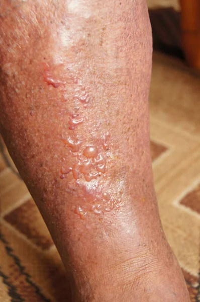 Water bubbles on the legs. Infectious and fungal diseases. Treatment ...